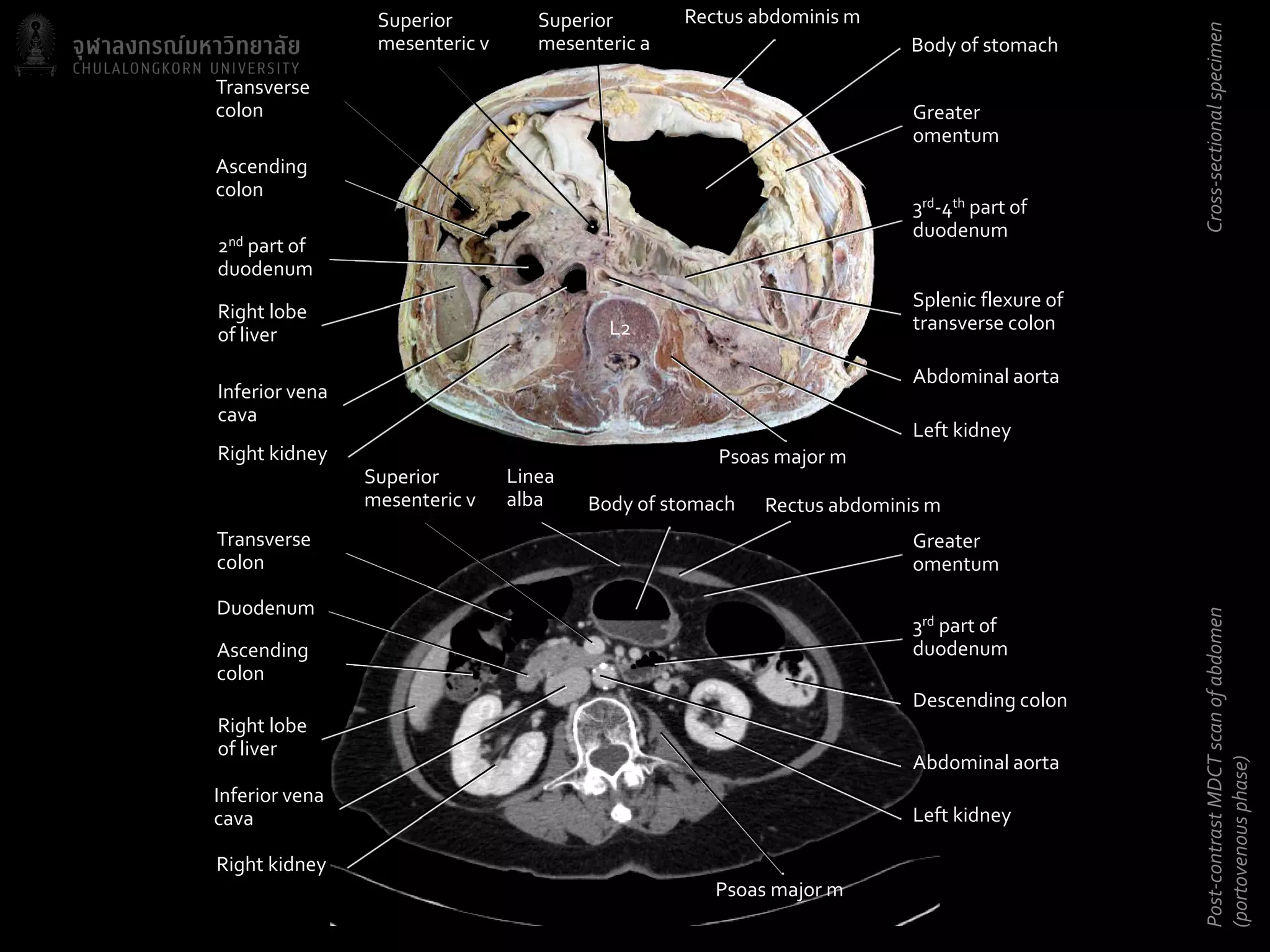 Topographic anatomy of abdomen | PDF