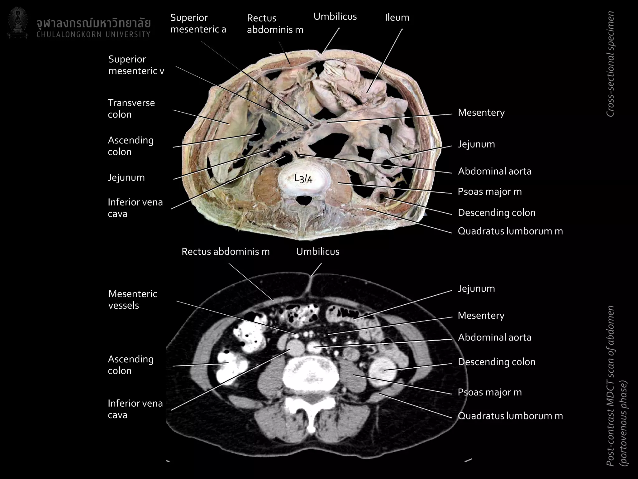 Topographic anatomy of abdomen | PDF
