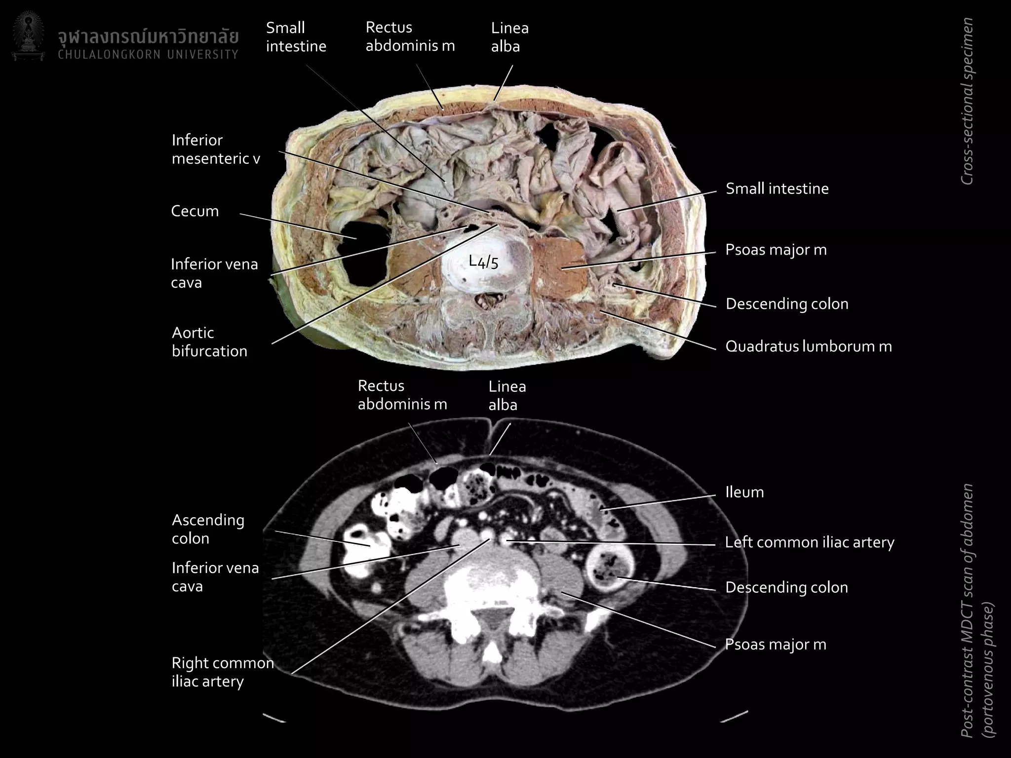 Topographic anatomy of abdomen | PDF