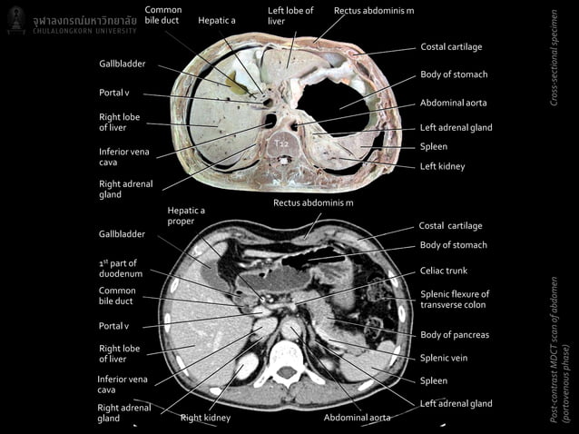 Topographic anatomy of abdomen | PDF