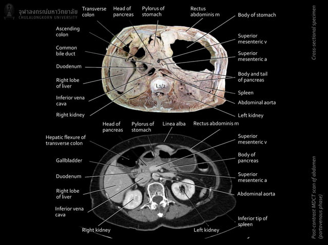 Topographic anatomy of abdomen | PDF