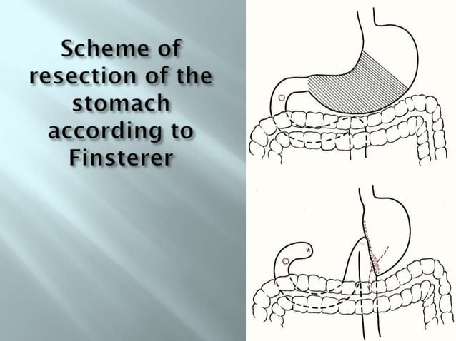 Topographic anatomy and operative surgery of the stomach.pdf