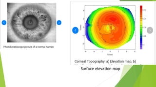 TOPOGRAPHY .pdf | Eye and Vision Conditions | Diseases and Conditions