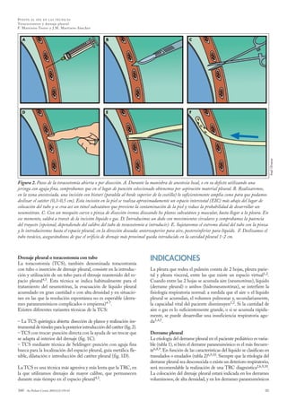 Toracocentesis | PDF