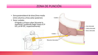 TORACOCENTESIS S E P A R EFUSION PLEURAL | PPTX