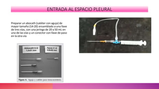 TORACOCENTESIS S E P A R EFUSION PLEURAL | PPTX