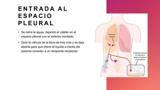 TORACOCENTESIS S E P A R EFUSION PLEURAL | PPTX