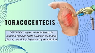 TORACOCENTESIS procedimiento médico quirúrgico | PPTX