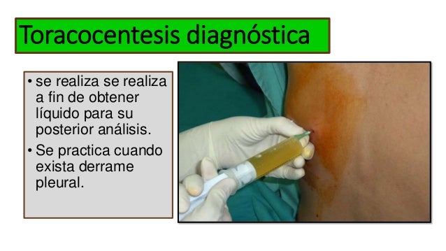 Toracocentesis