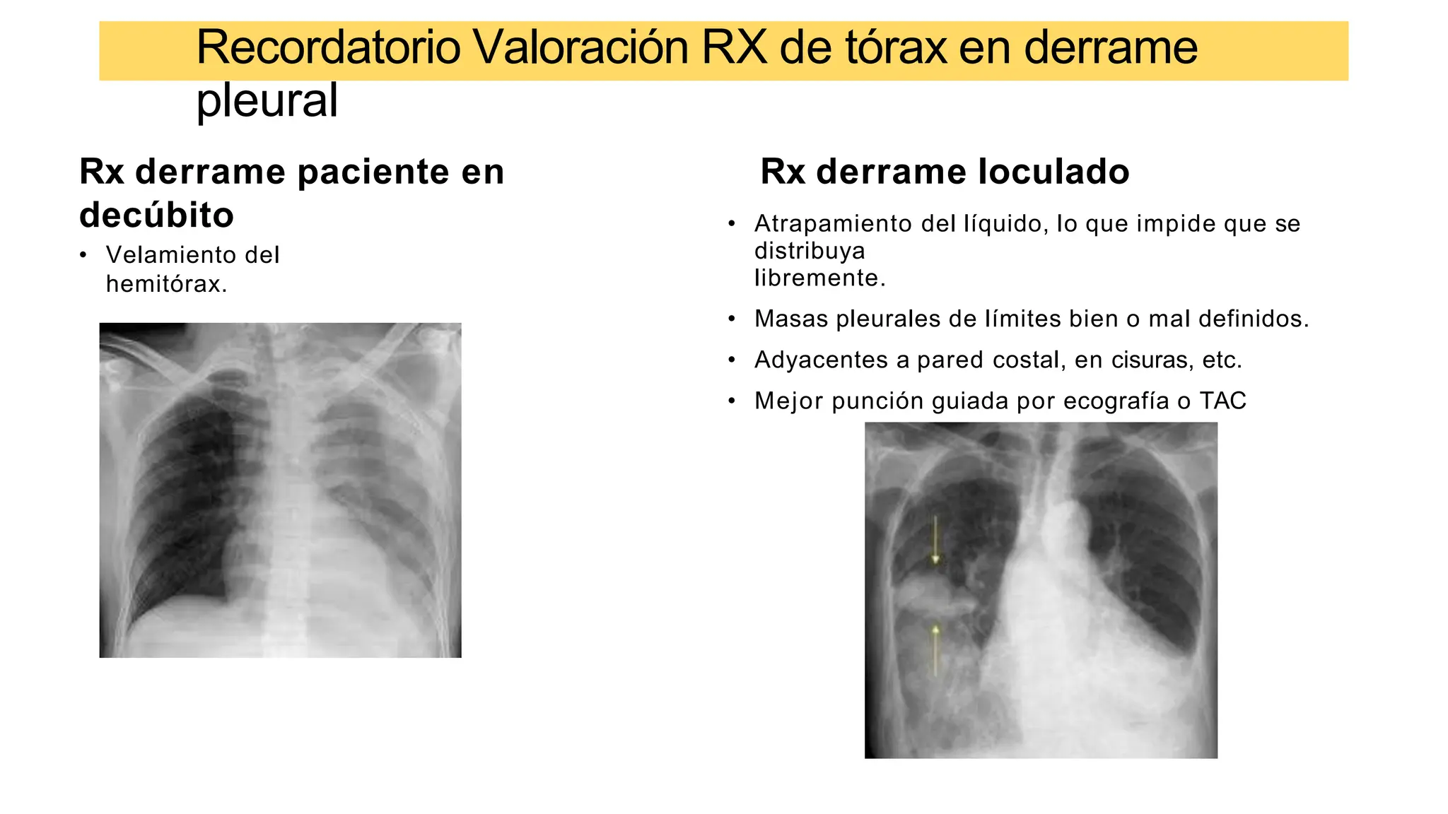 TORACOCENTESIS DERRAME PLEURAL EXPO PARA ENTENDER EL PROCEDIMIENTO | PPTX