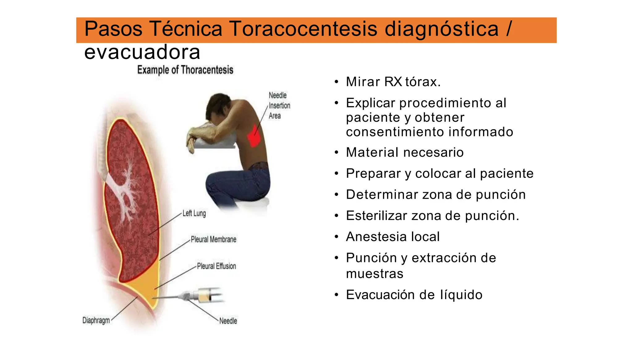 TORACOCENTESIS DERRAME PLEURAL EXPO PARA ENTENDER EL PROCEDIMIENTO | PPTX