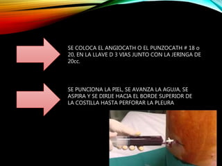 Toracocentesis e insercion de sonda pleural | PPTX