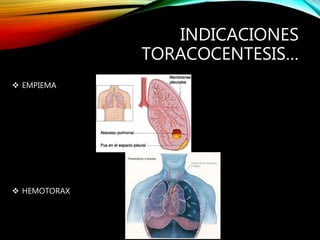 Toracocentesis e insercion de sonda pleural | PPTX