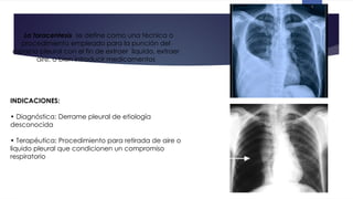 toracocentesis anatomia,tecnica y procedimiento.pptx