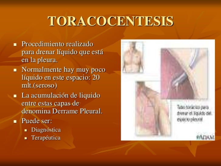 Toracocentesis Y Drenaje Toracico