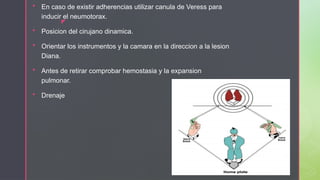 TORACOSCOPIA PROCEDIMIENTO QUIRURGICO.pptx
