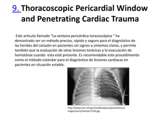 Toracoscopia Gloria Quintero | PPTX