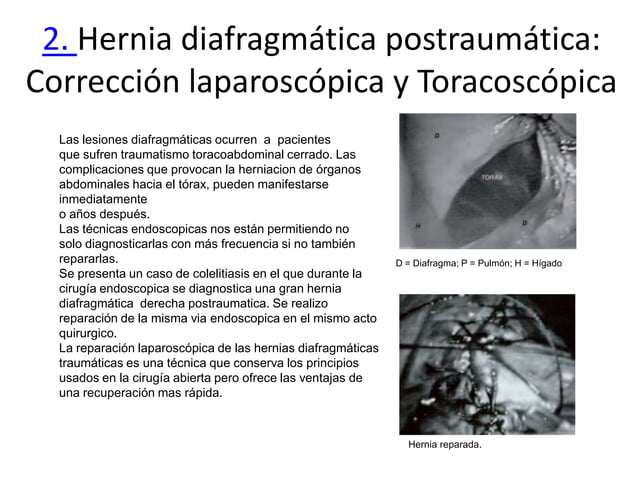 Toracoscopia Gloria Quintero | PPT