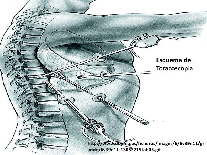 Toracoscopia Gloria Quintero