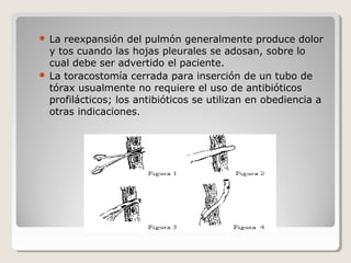 Toracostomía | PPT