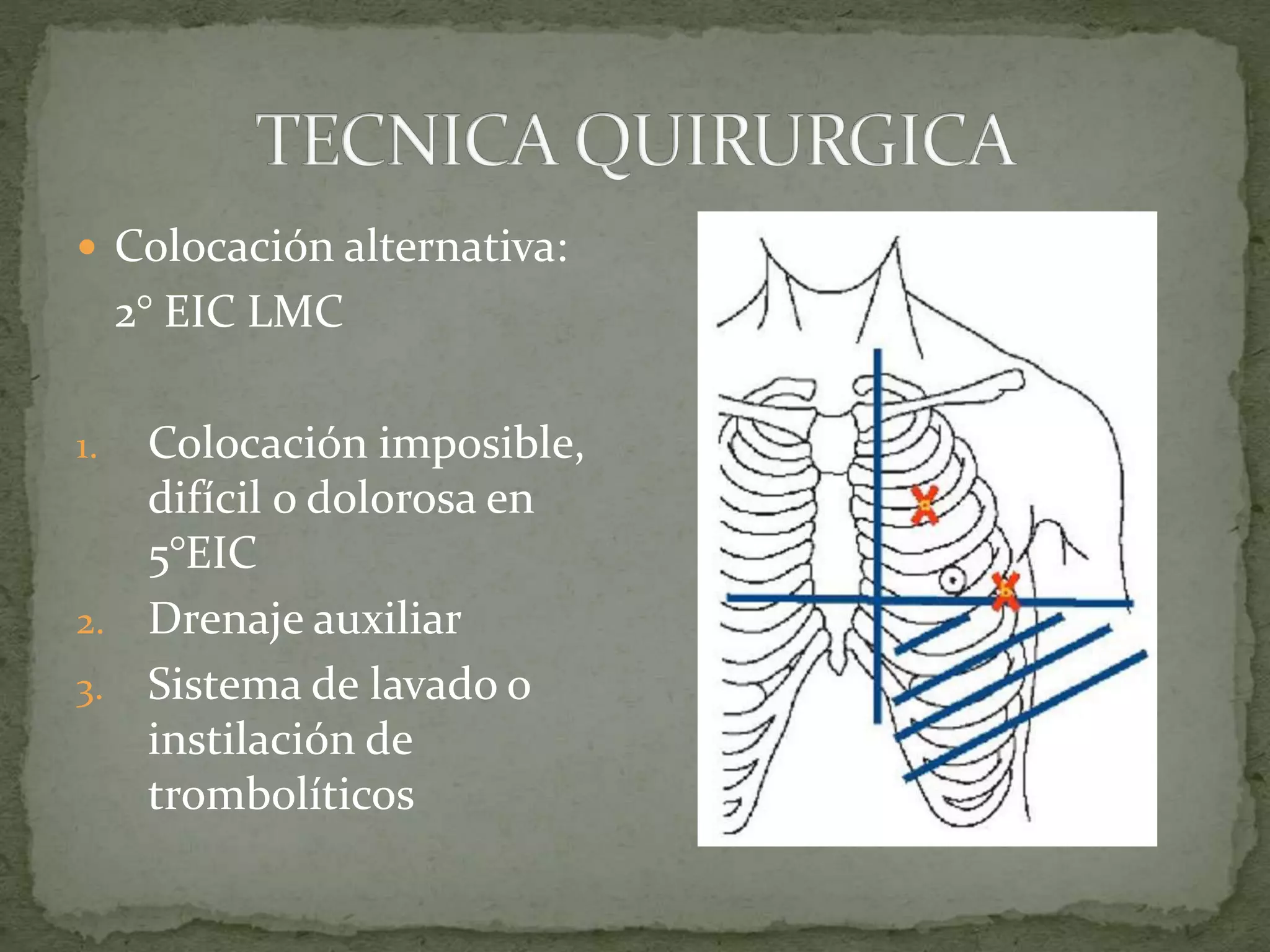 Toracostomia con tubo | PPT | Descarga Gratuita