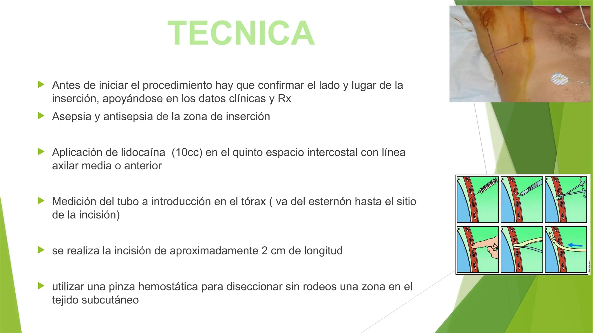 toracostomia y toracotomia en unidad de cuidados intensivos.pptx