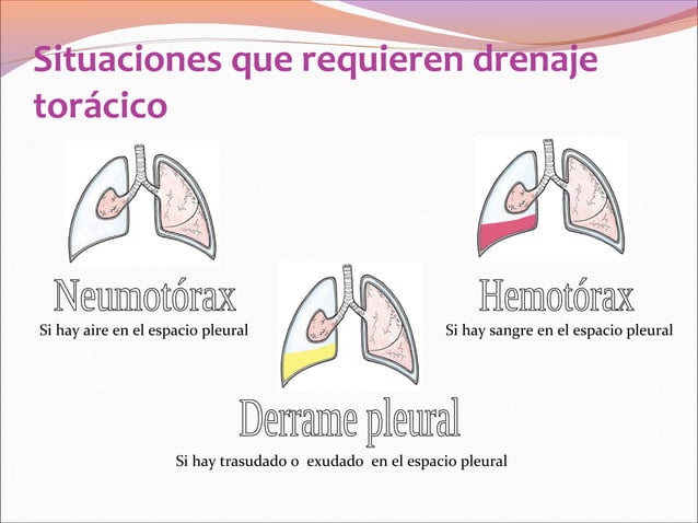 TORACOTOMÍA MÍNIMA