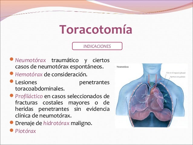 TORACOTOMÍA MÍNIMA
