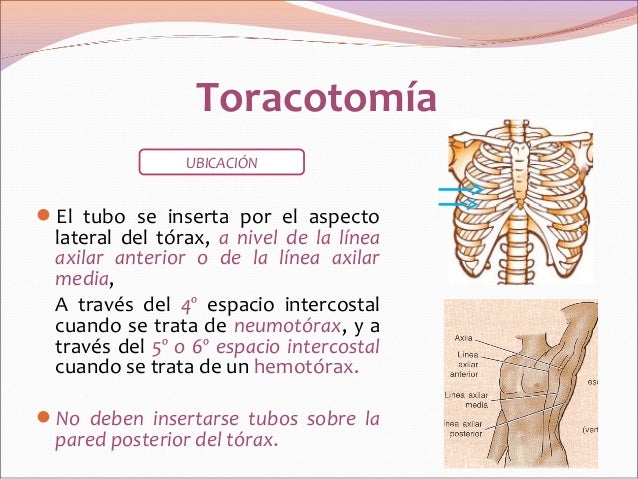 TORACOTOMÍA MÍNIMA