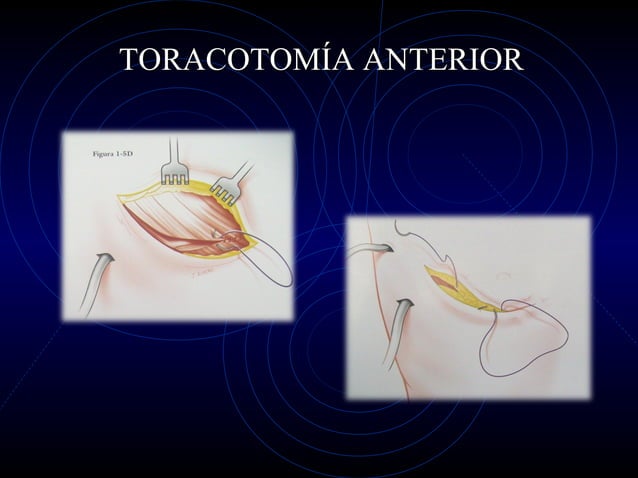Toracotomias | PPT