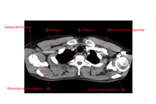 Tórax anatomía TAC | PPTX