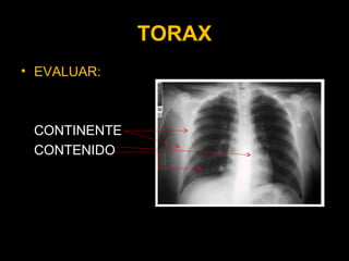 Torax | PPT