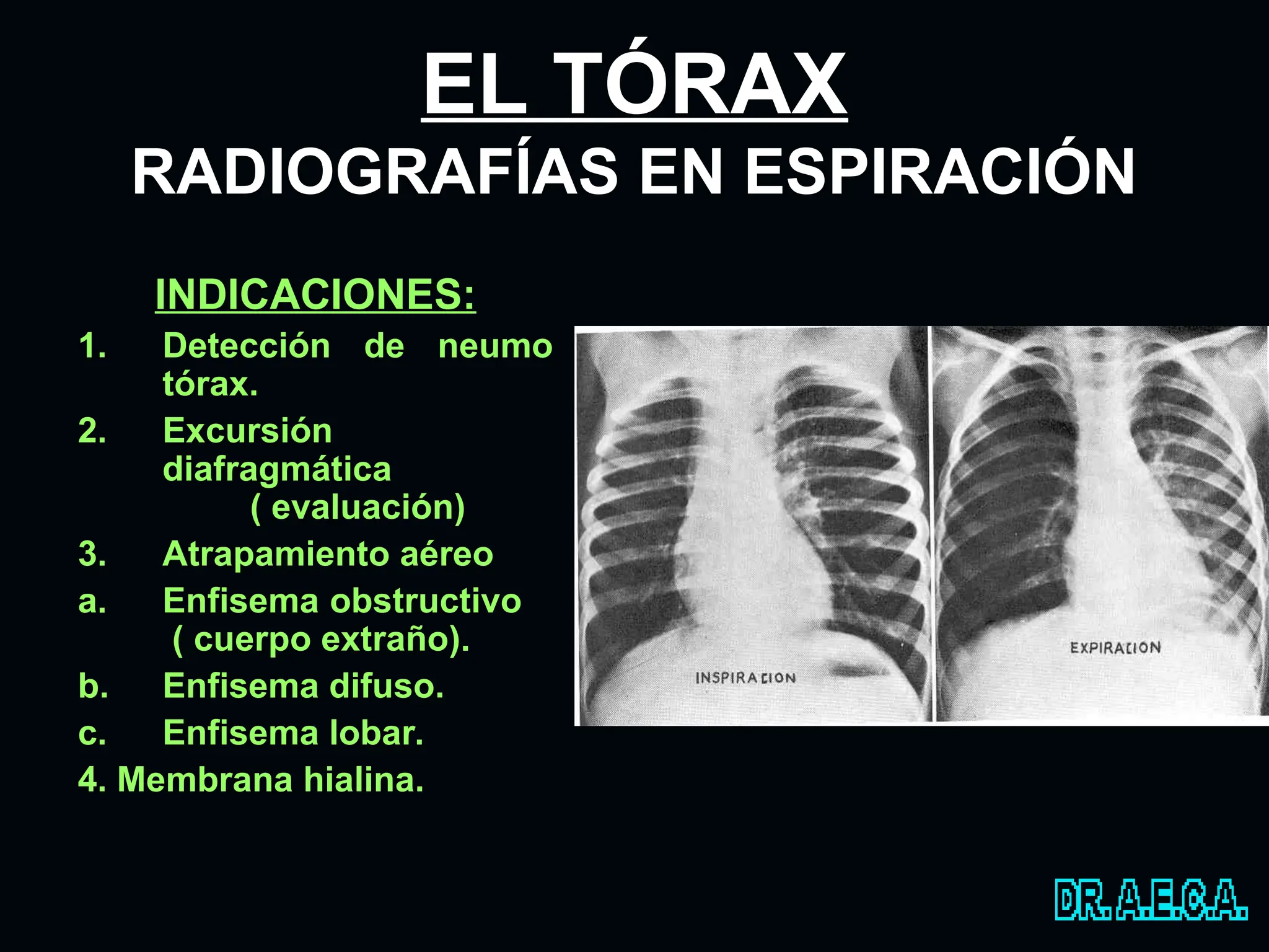 Imagenologia de torax, interpretacion de imagenes | PPT