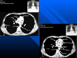 Radiología del Tórax 1-Medicina en imagen.ppt