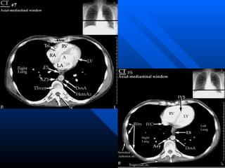 Radiología del Tórax 1-Medicina en imagen.ppt