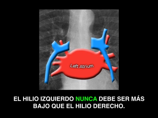 TORAX 2 PARTE (SILUETA CARDIACA E HILIOS) | PDF