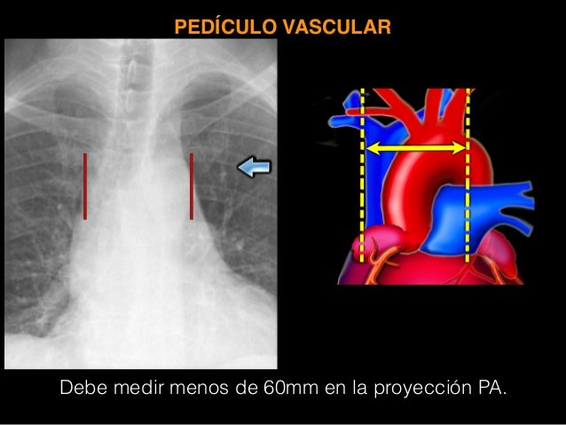 TORAX 2 PARTE (SILUETA CARDIACA E HILIOS)