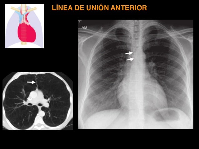 TORAX 2 PARTE (SILUETA CARDIACA E HILIOS)