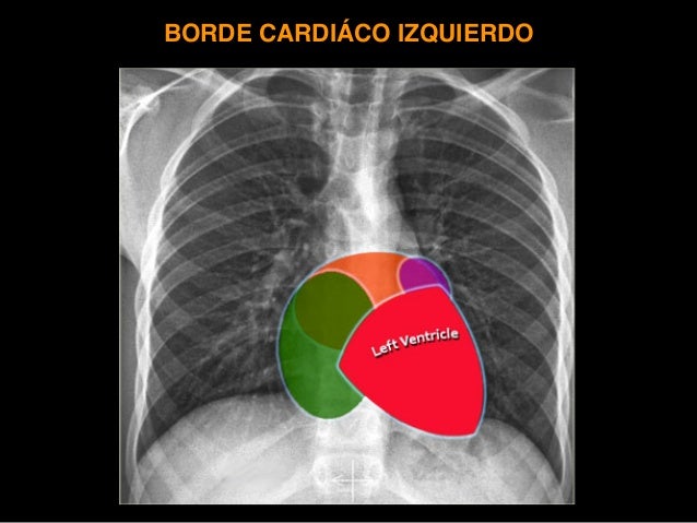 TORAX 2 PARTE (SILUETA CARDIACA E HILIOS)