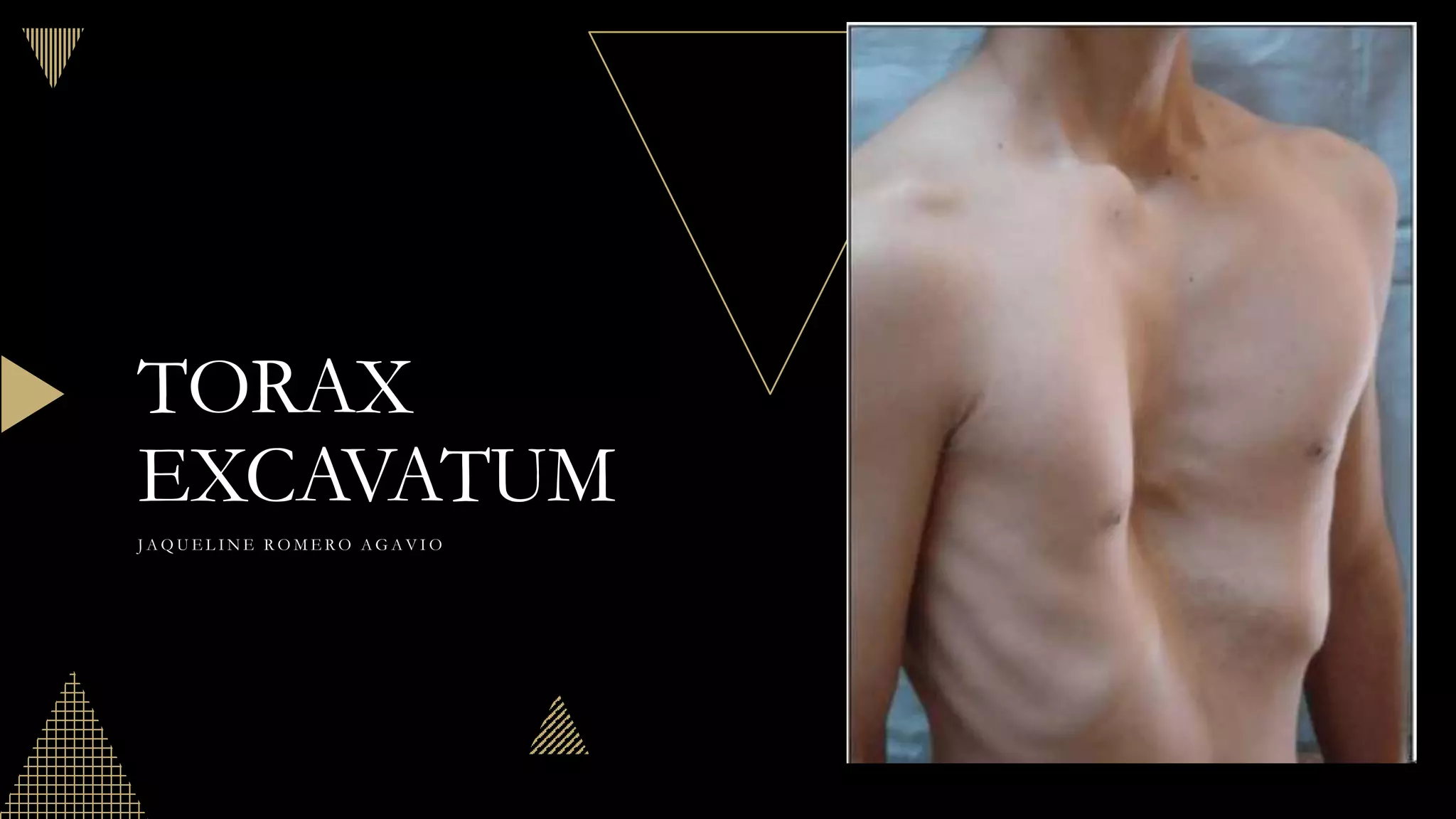 TORAX EXCAVATUM y carinatum.pptx | Surgery | Medical Health