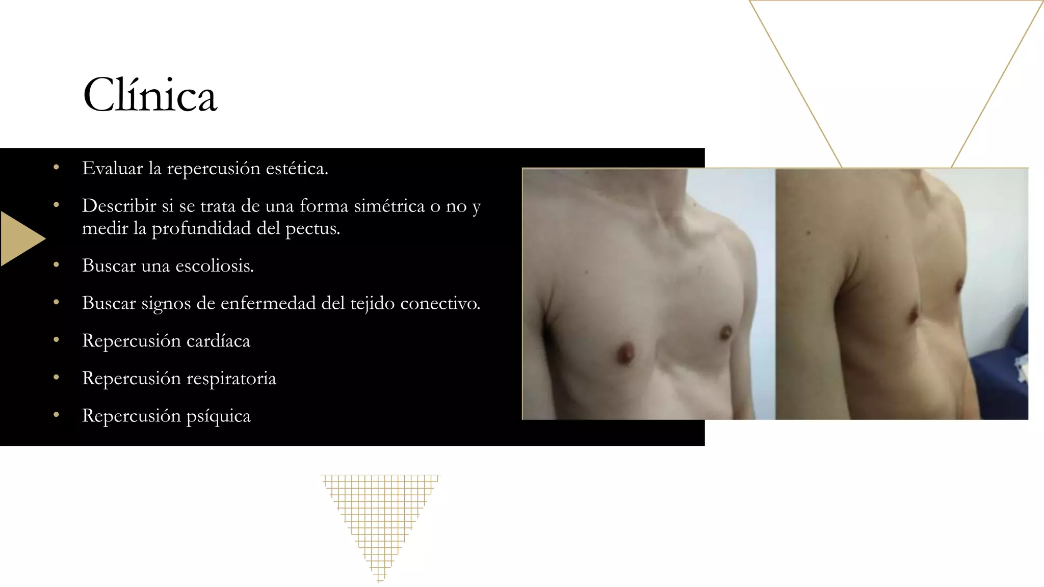 TORAX EXCAVATUM y carinatum.pptx | Surgery | Medical Health
