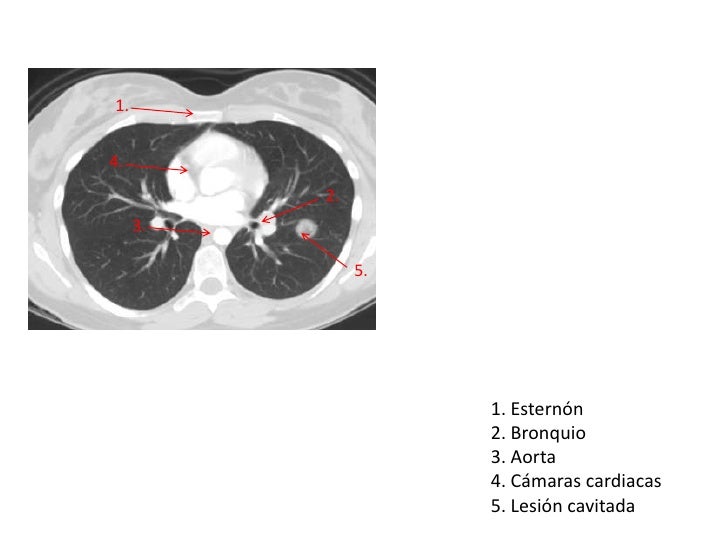 Tac Torax Patron Nodular