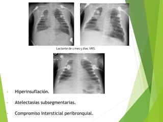 Torax en Neonatologia | PPTX