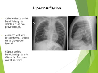 Torax en Neonatologia | PPTX