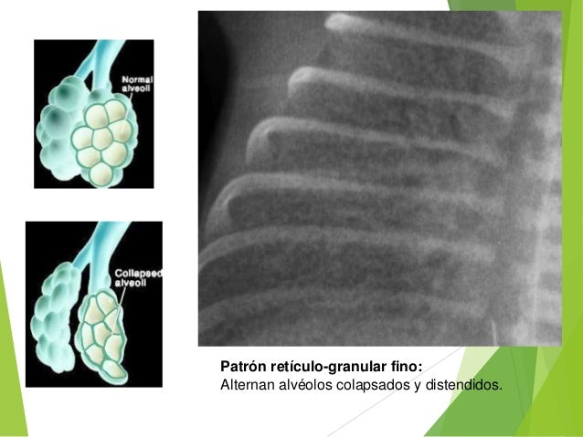 Torax en Neonatologia