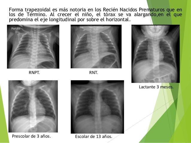 Torax en Neonatologia