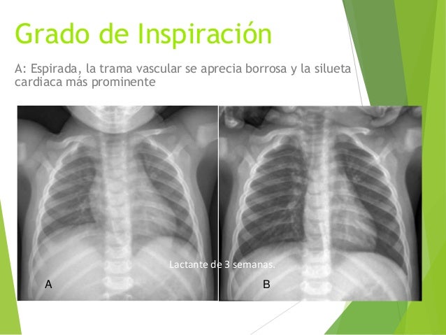 Torax en Neonatologia