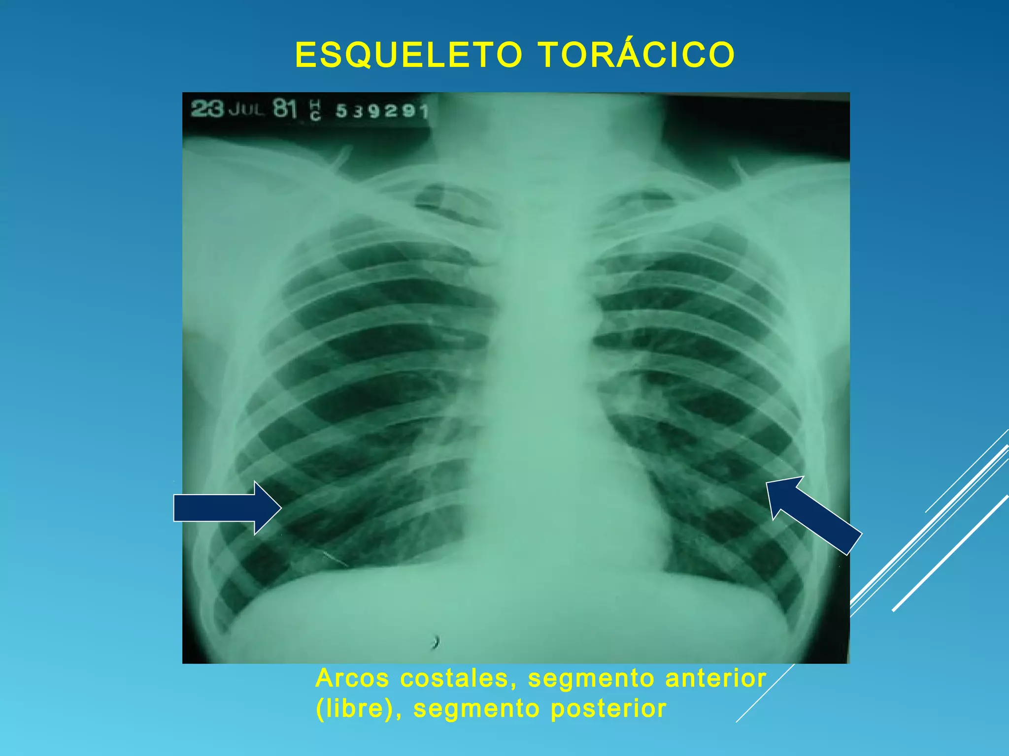Torax normal en Imagenología | PPT | Lung and Respiratory Health ...