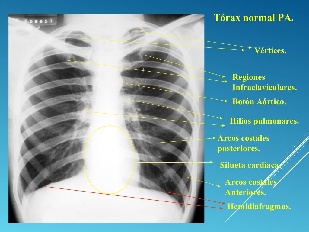 Torax normal en Imagenología