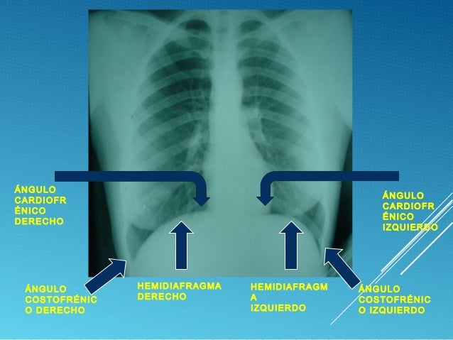 Torax Normal En Imagenología